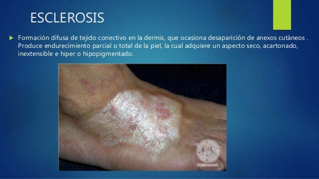 Dermatologia Lesiones elementales