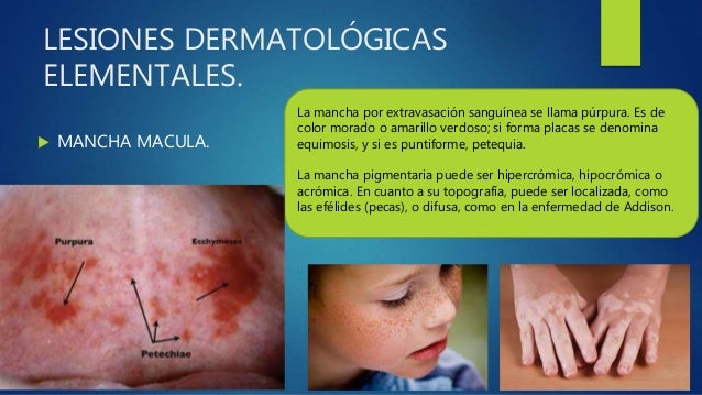Dermatologia Lesiones elementales