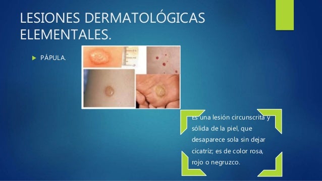 Dermatologia Lesiones elementales