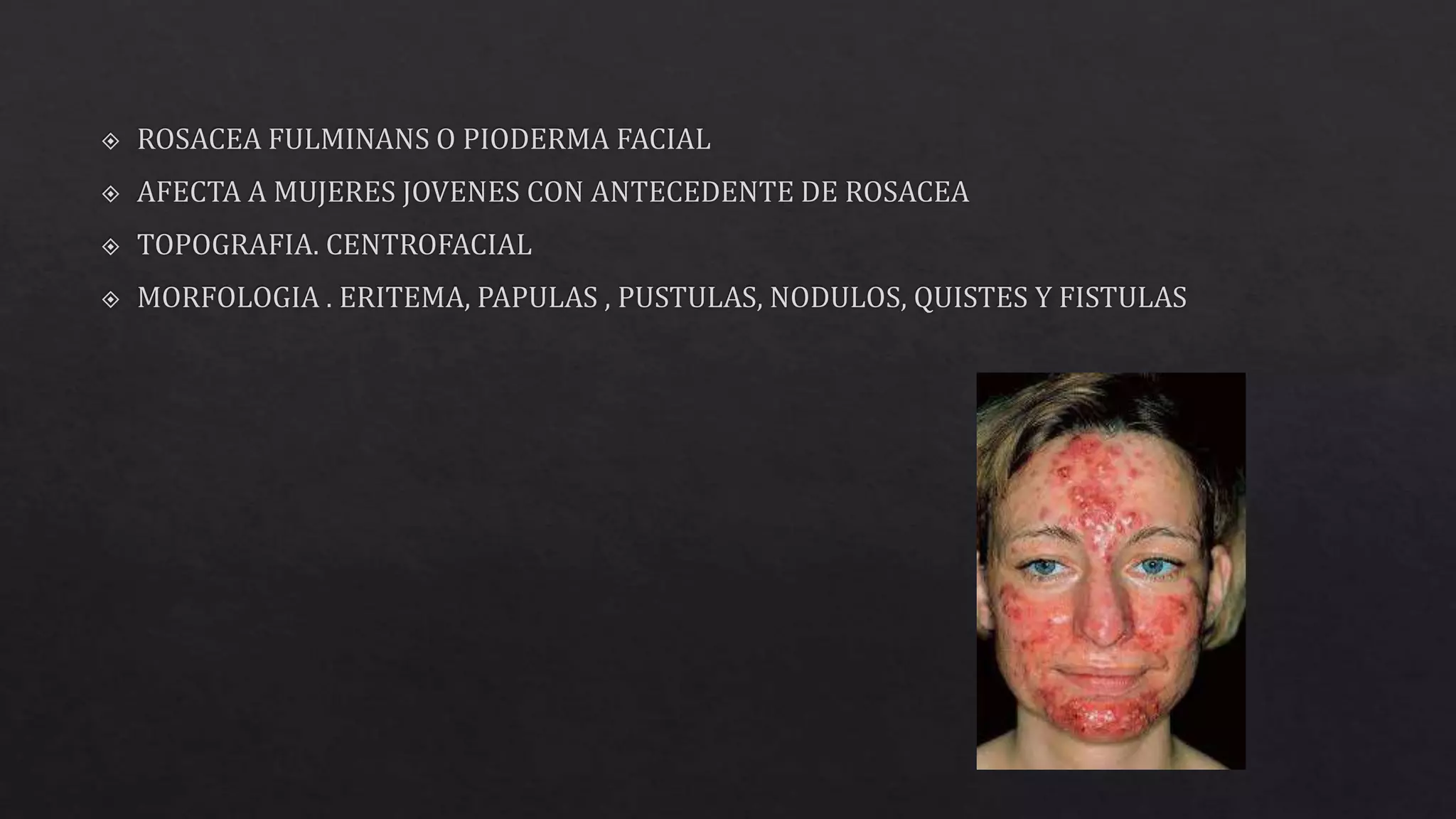 Acne, rosacea,dermatitis seborreica, SAHA y SAPHO | PPTX