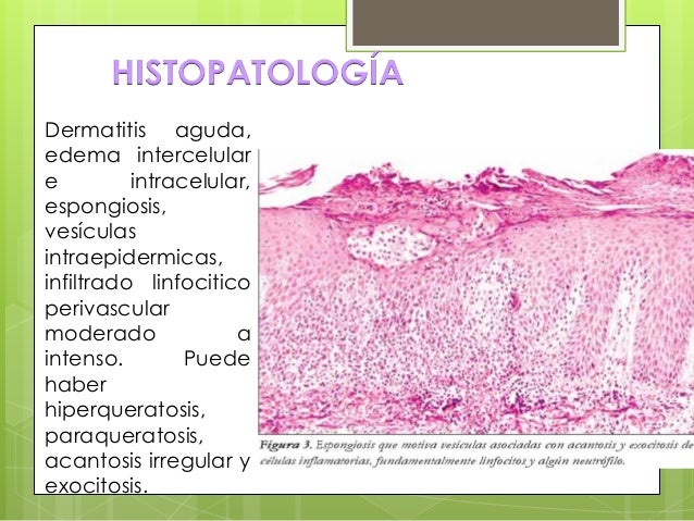 dermatitis atopica y eccema numular