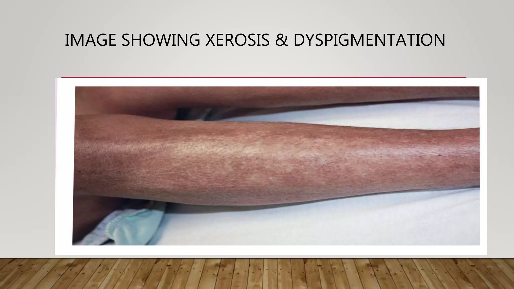 Dermatological complication in chronic kidney disease | PPTX