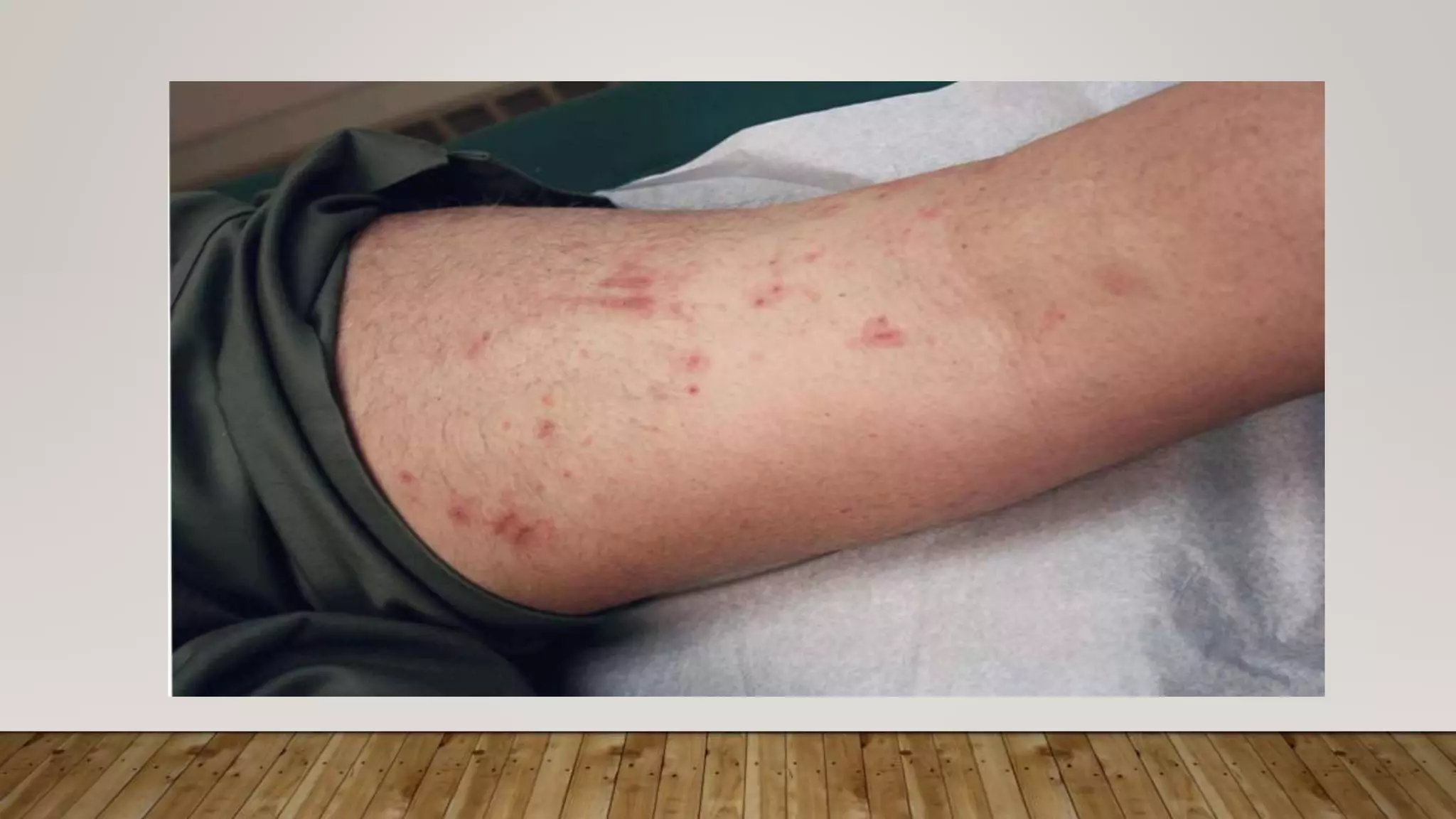 Dermatological complication in chronic kidney disease | PPTX