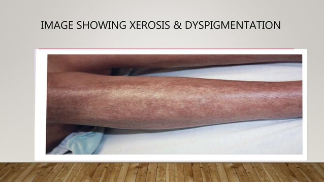 Dermatological complication in chronic kidney disease | PPTX | Skin and ...