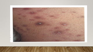 Dermatological complication in chronic kidney disease | PPTX