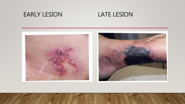 Dermatological complication in chronic kidney disease | PPTX | Skin and ...