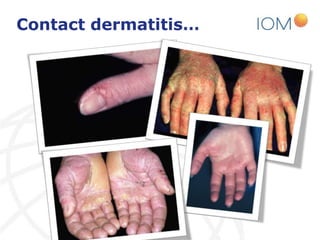 An introduction to dermal exposure assessment | PPTX