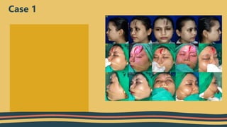DERMAL FAT GRAFTING AS A THERAPEUTIC INTERVENTION FOR.pptx