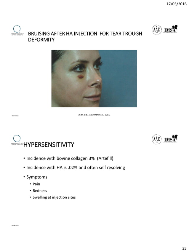 Dermal filler from basic to practice | PDF | Skin and Dermatology ...