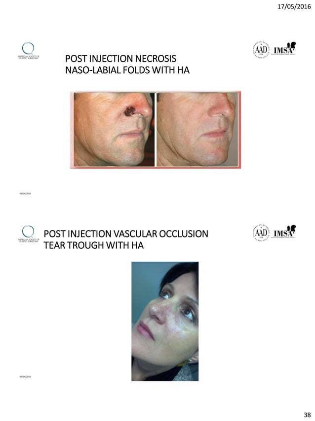 Dermal filler from basic to practice | PDF | Skin and Dermatology ...