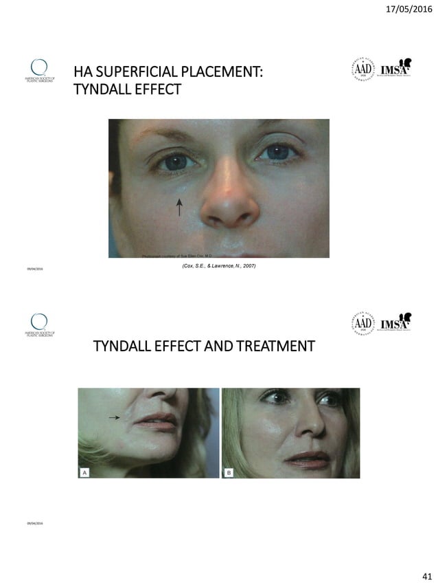 Dermal filler from basic to practice | PDF | Skin and Dermatology ...