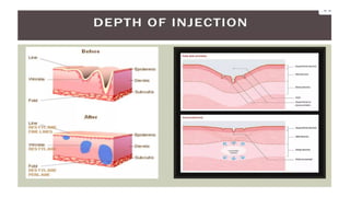 DERMAL FILLERS including anatomy, injection points , complications and ...