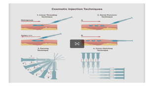 DERMAL FILLERS including anatomy, injection points , complications and ...