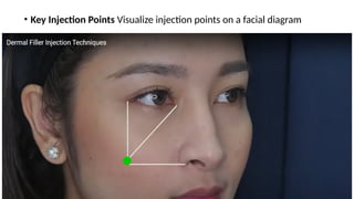 DERMAL FILLERS including anatomy, injection points , complications and ...