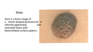 Dermal Naevus copy Dr syeda Madiha har.pptx