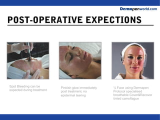 Denver Dermapen Training - Debbie Brinkman | PPT