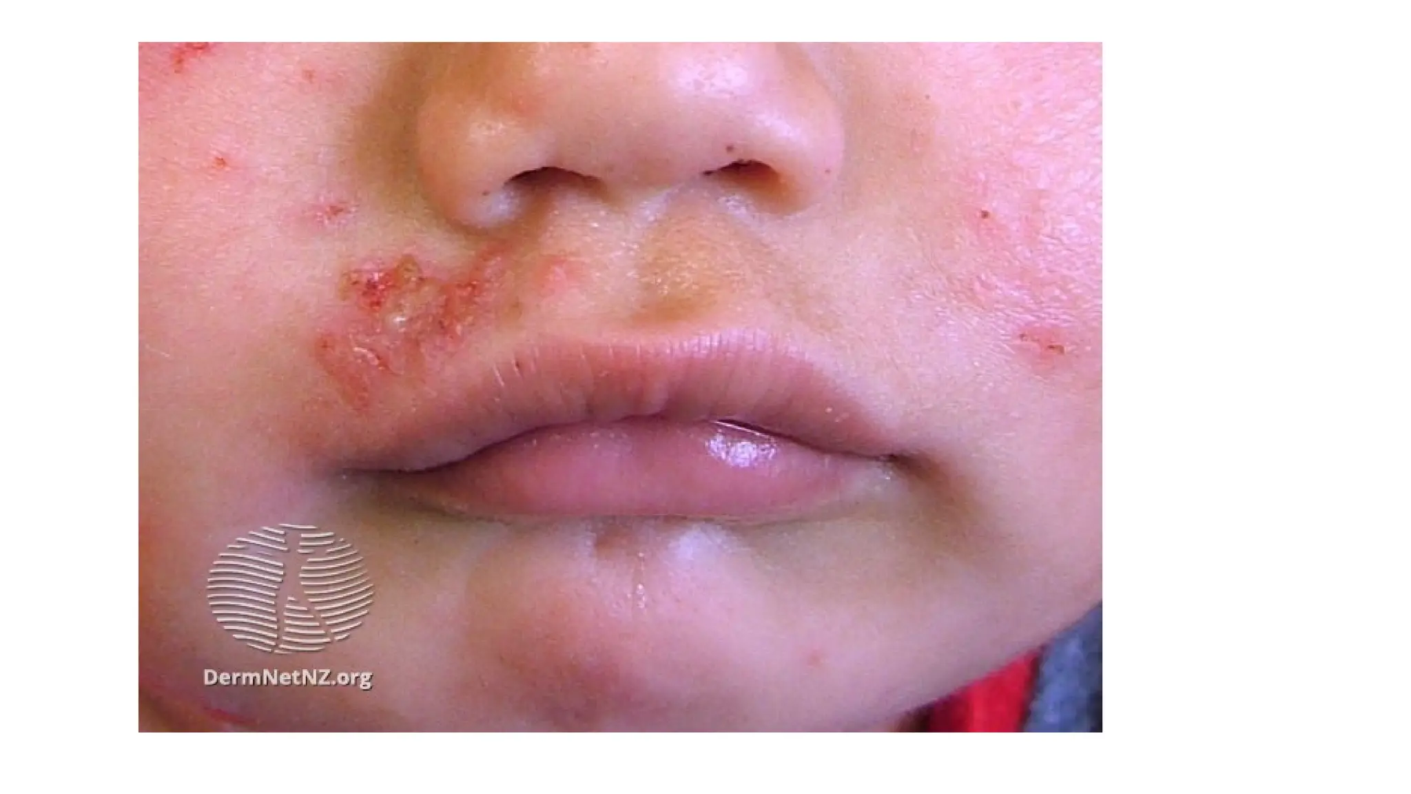 derma piics all skin diseases pictures.pptx