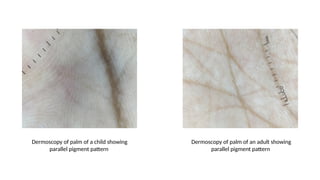 Dermoscopy in Dermatology: Principles, Patterns, and Clinical ...