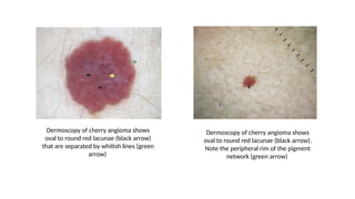 Dermoscopy in Dermatology: Principles, Patterns, and Clinical ...