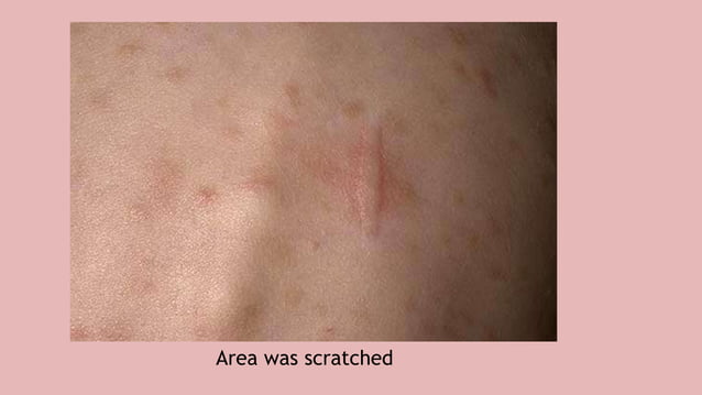 Derma signs | PPTX | Skin and Dermatology | Diseases and Conditions