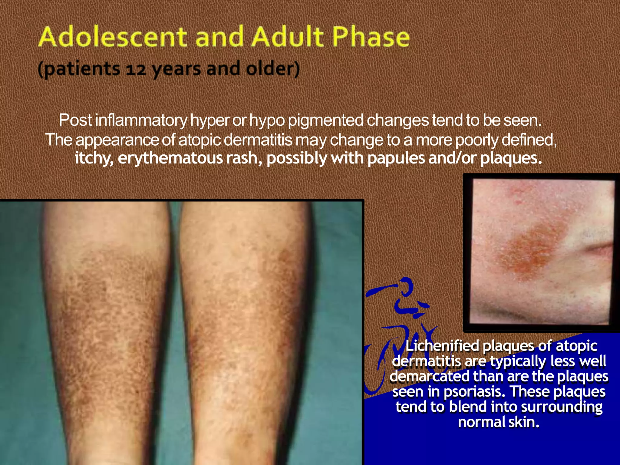 Dermatitis eczema by dr.Hari dagal | PPTX