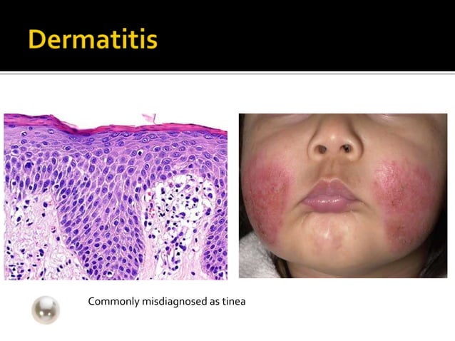 Dermatitis | PPTX