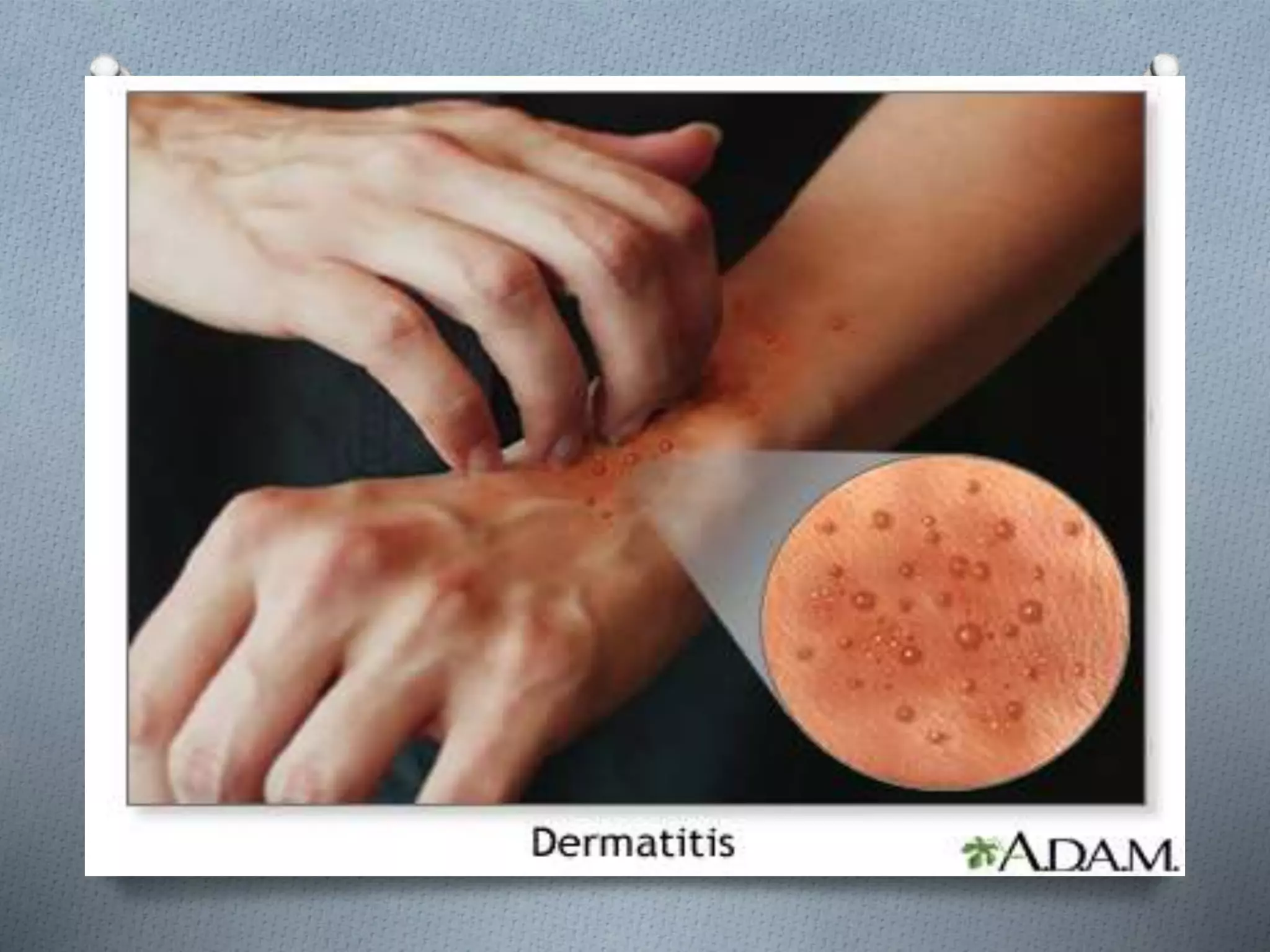 Dermatitis | PPT