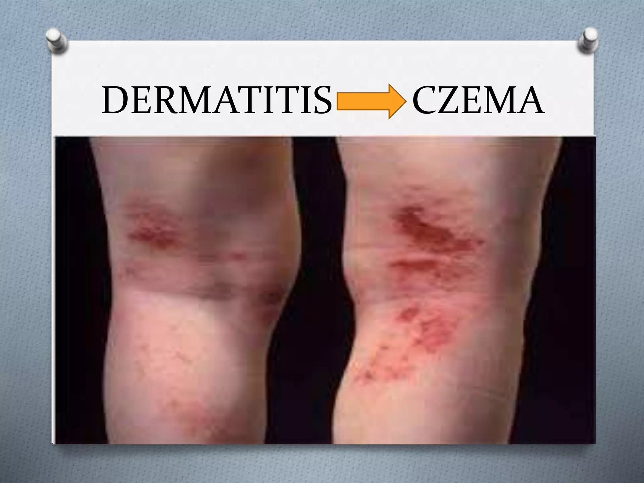 Dermatitis | PPT