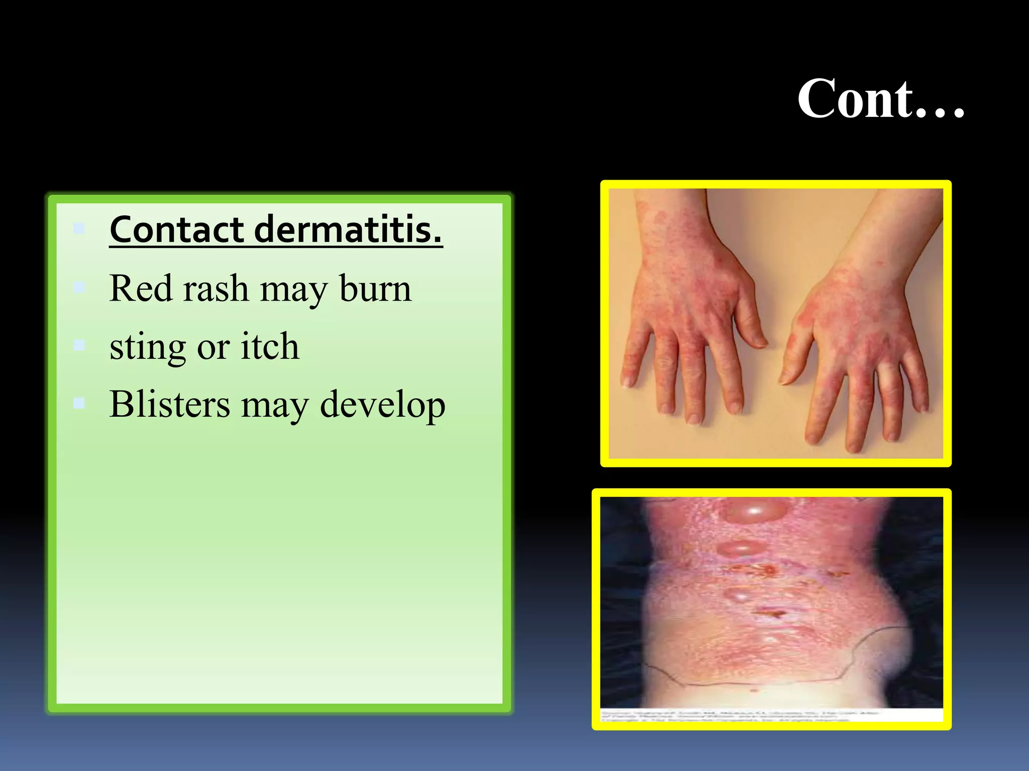 Dermatitis | PPTX | Skin and Dermatology | Diseases and Conditions