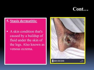 Dermatitis | PPTX
