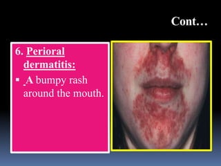 Dermatitis | PPTX