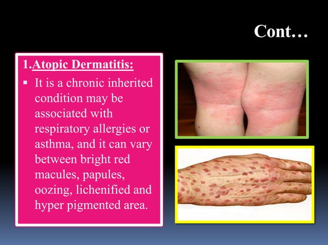 Dermatitis | PPTX | Skin and Dermatology | Diseases and Conditions