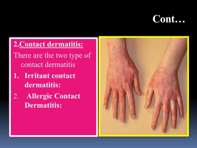 Dermatitis | PPTX | Skin and Dermatology | Diseases and Conditions