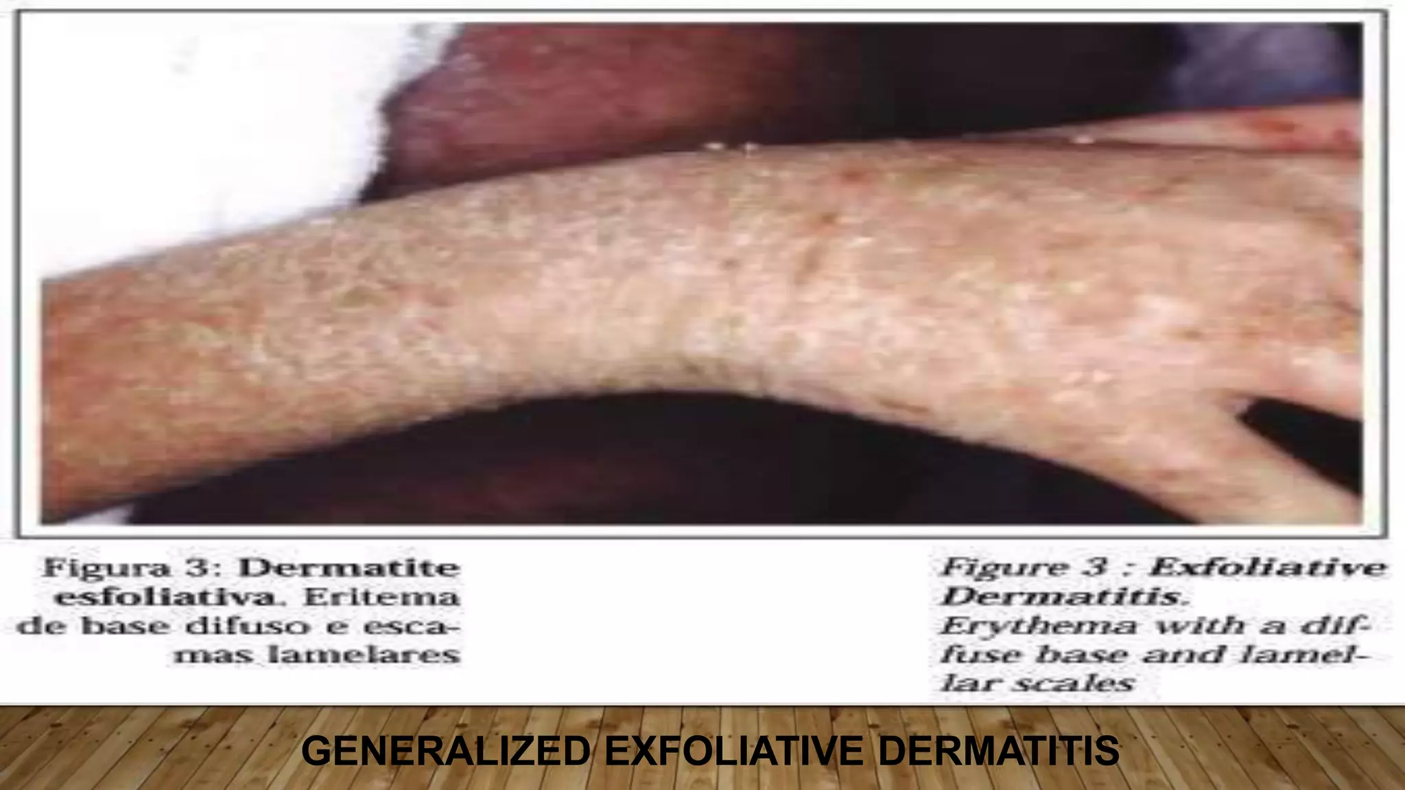Dermatitis ppt | PPTX