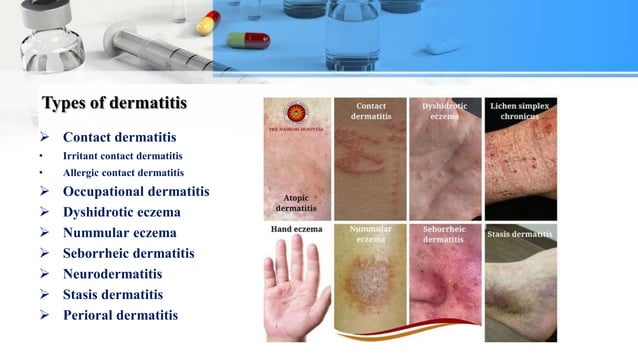 Dermatitis.pptx