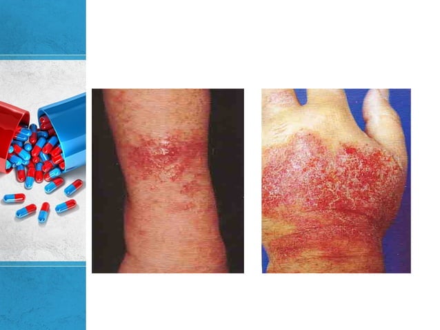 Dermatitis pada manusia .ppt