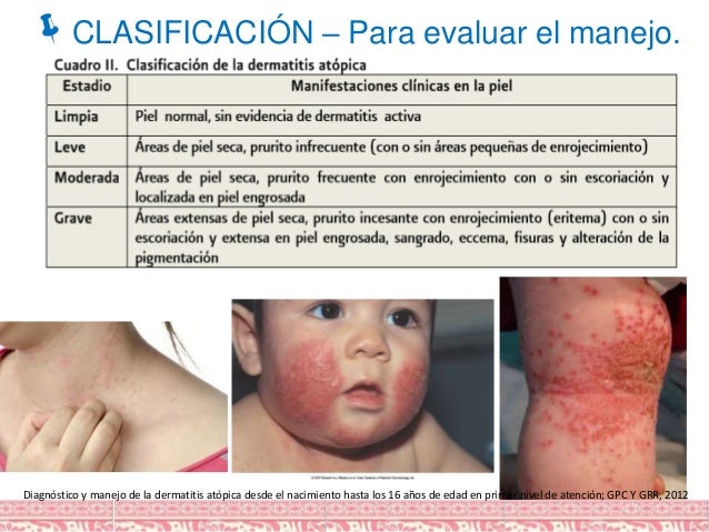 Dermatitis atopica