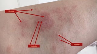 DERMATITIS ATOPICA - PRURIGO NODULAR- INTERTRIGO PEDIATRIA | PPTX