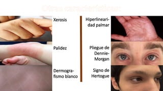 DERMATITIS ATOPICA - PRURIGO NODULAR- INTERTRIGO PEDIATRIA | PPTX