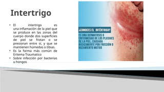 DERMATITIS ATOPICA - PRURIGO NODULAR- INTERTRIGO PEDIATRIA | PPTX