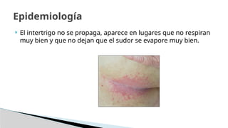 DERMATITIS ATOPICA - PRURIGO NODULAR- INTERTRIGO PEDIATRIA | PPTX