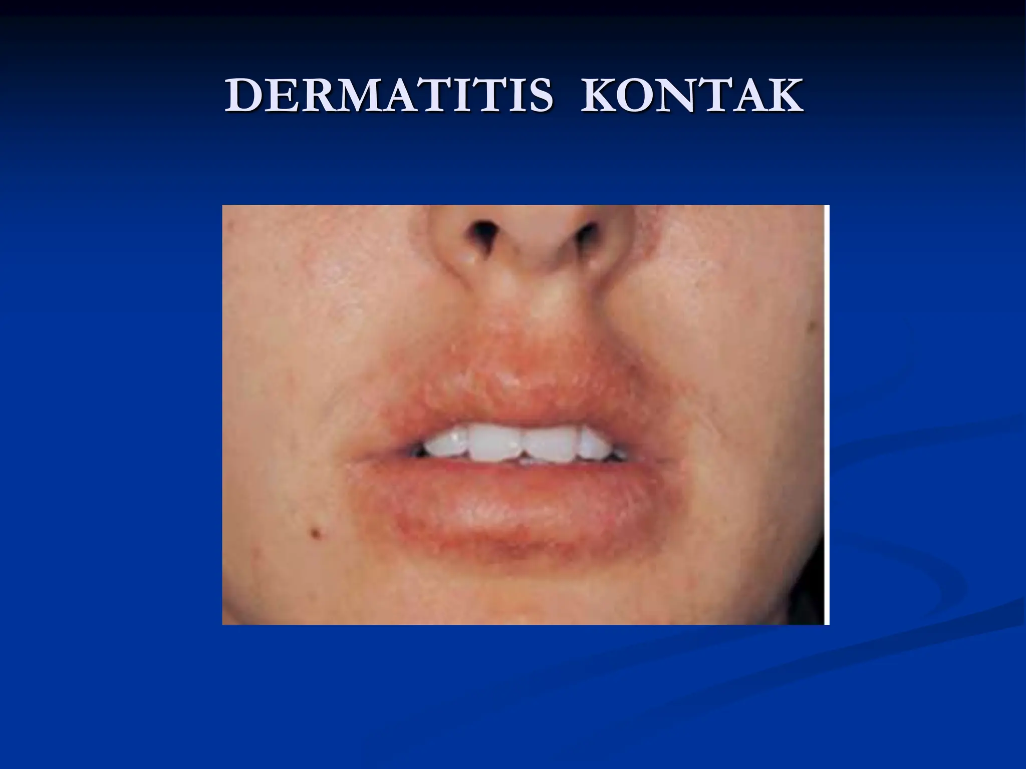 Dermatitis afrizal .ppt