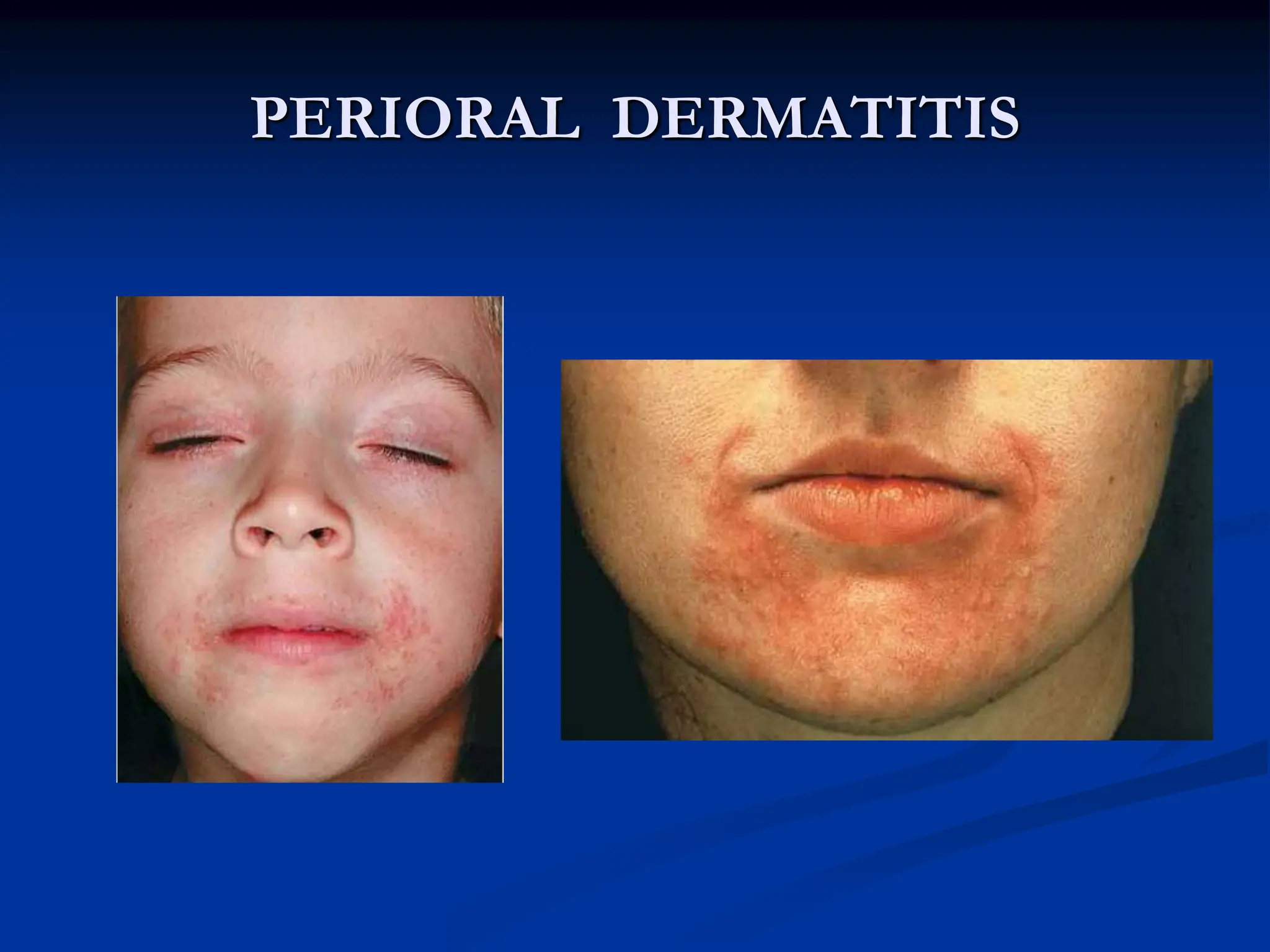 Dermatitis afrizal .ppt