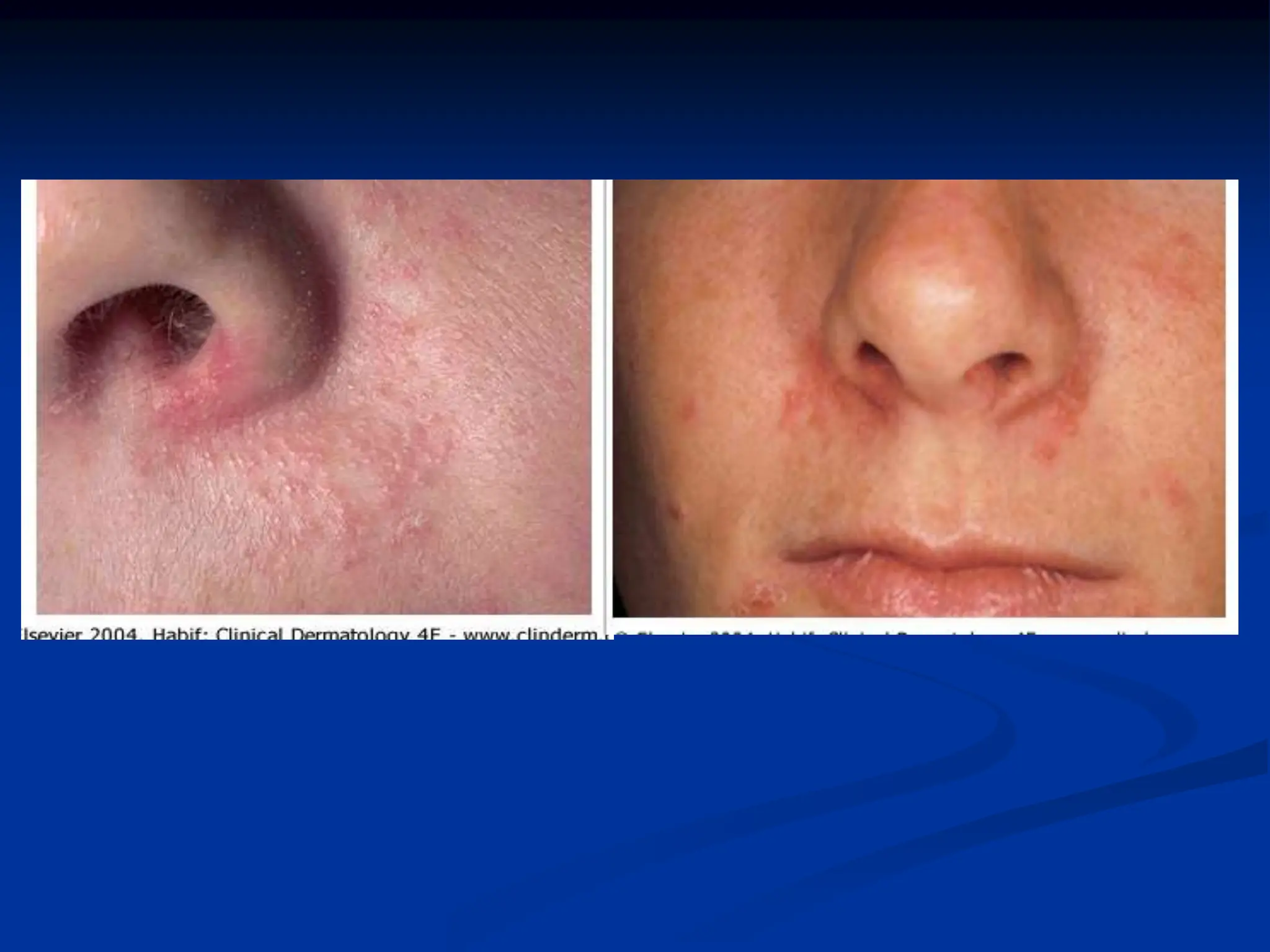 Dermatitis afrizal .ppt