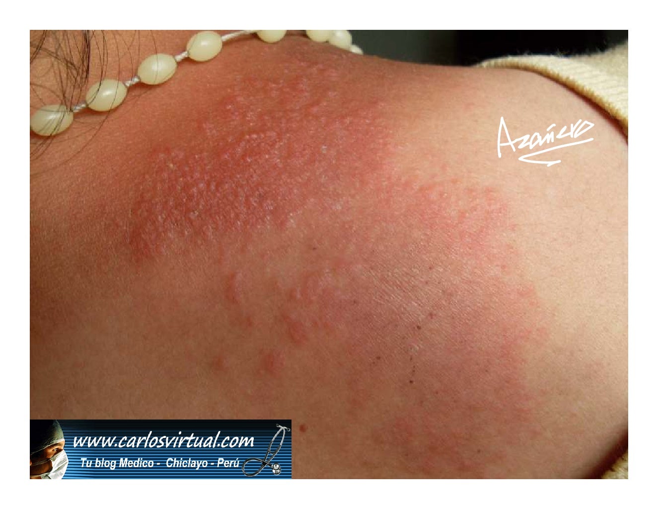 Dermatitis Alergica
