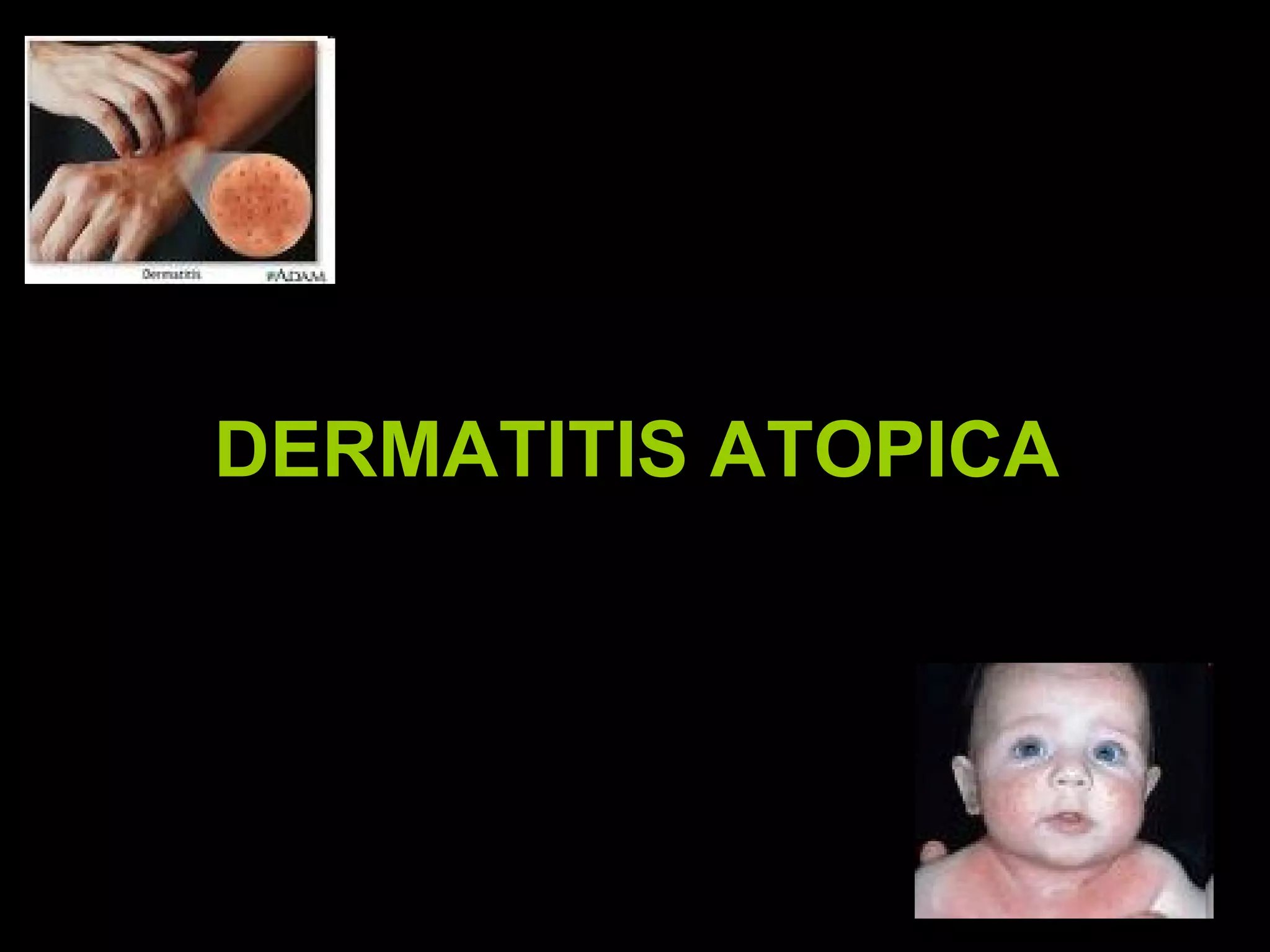 Dermatitis Atopica | PPT