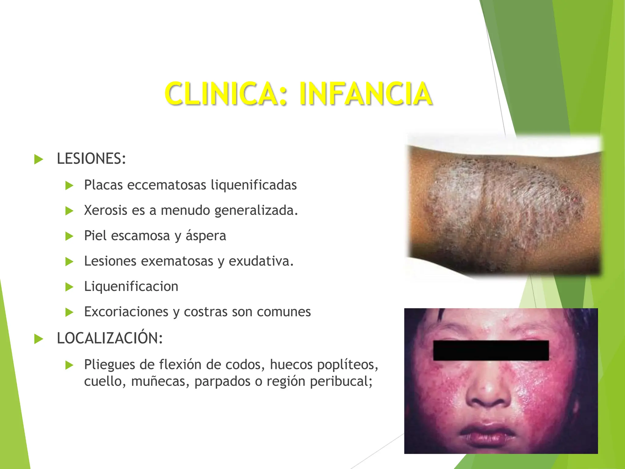 dermatitis atopica definicion patologia clasificacion y tratamiento | PPT