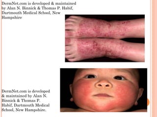 Dermatitis atopica | PPT