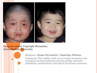 Dermatitis atopica | PPT