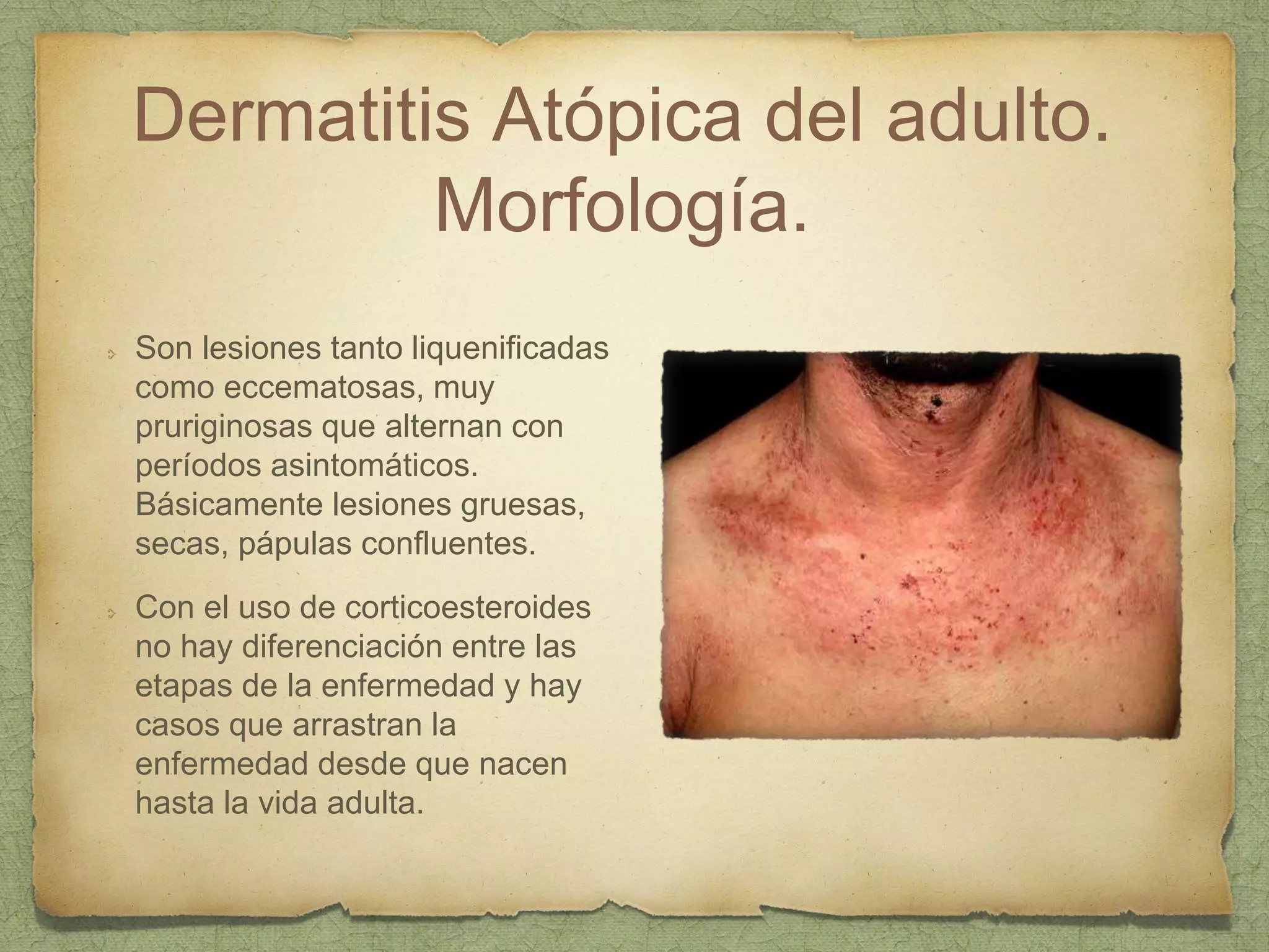 Dermatitis atópica. Dermatología. | PPT | Descarga Gratuita